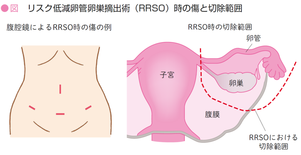 遺伝性乳がん卵巣がんを知ろう！